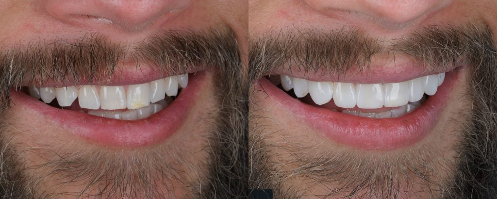 Composite Bonding Weybridge - Teeth Bonding Addlestone